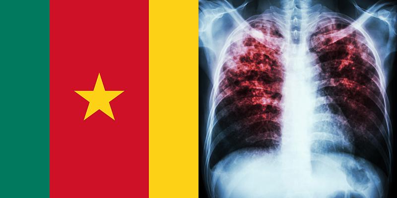 Tuberculosis in Cameroon