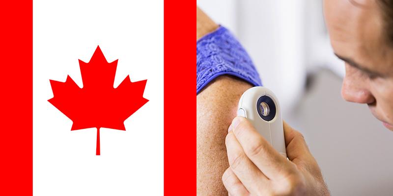 Skin Cancers in Canada