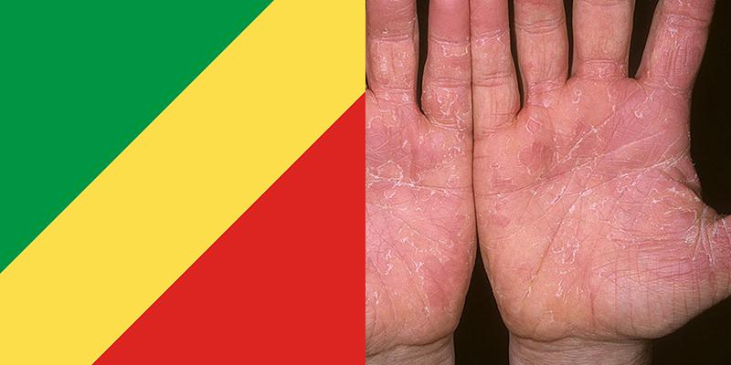 Skin Disease in Congo