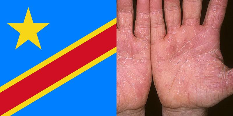 콩고 민주 공화국에서 피부병