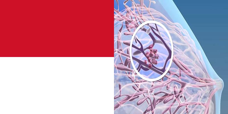 Breast Cancer in Indonesia