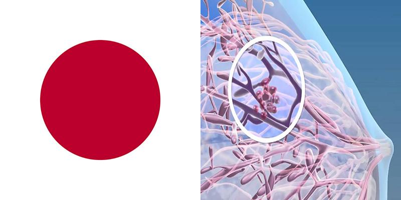Breast Cancer in Japan
