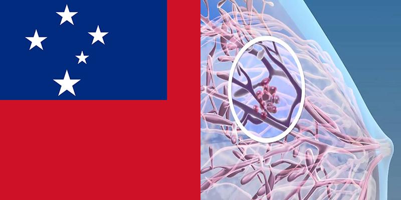 Breast Cancer in Samoa