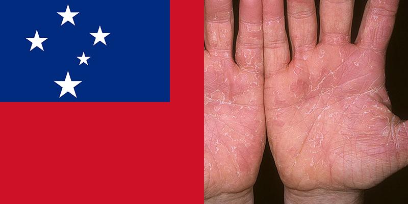 Skin Disease in Samoa