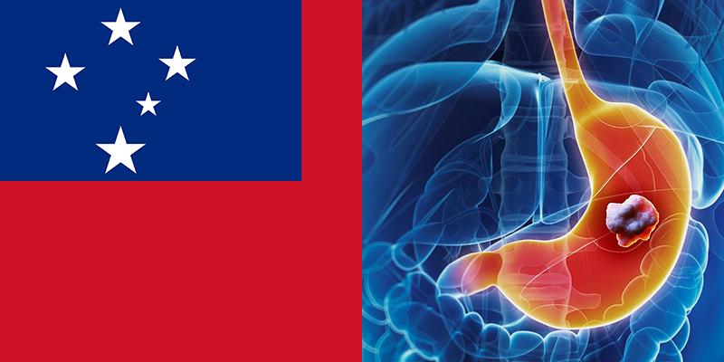 Stomach Cancer in Samoa
