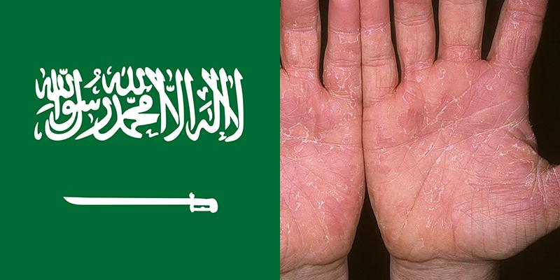 Skin Disease in Saudi Arabia