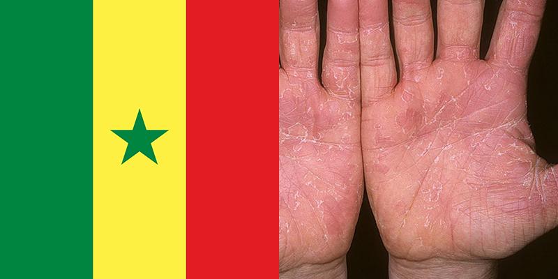 Skin Disease in Senegal
